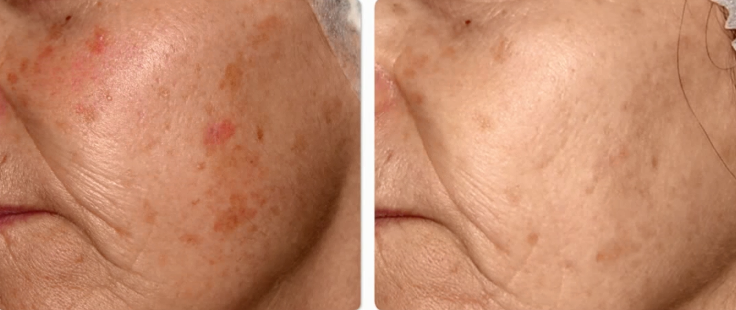 Addisons Disease Skin Pigmentation Pictures